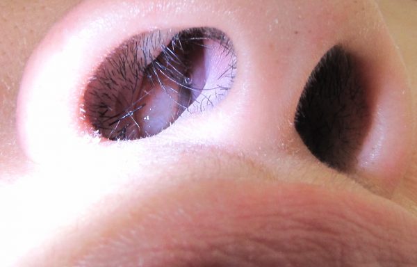 Ethmoidal polyp | Causes, Symptoms, Treatment options