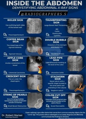 Ethmoidal polyp | Causes, Symptoms, Treatment options