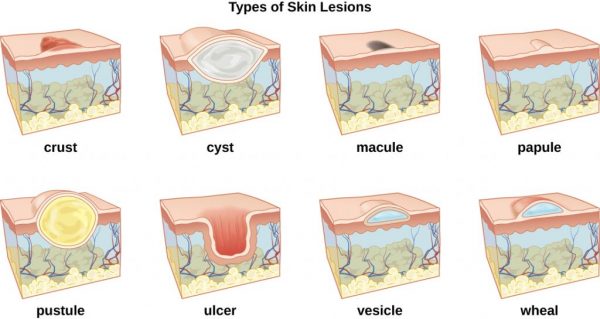 Ethmoidal polyp | Causes, Symptoms, Treatment options